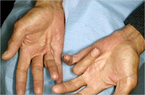 Straightening Bent Fingers, No Surgery Required | Dr. Glickel & The NY ...