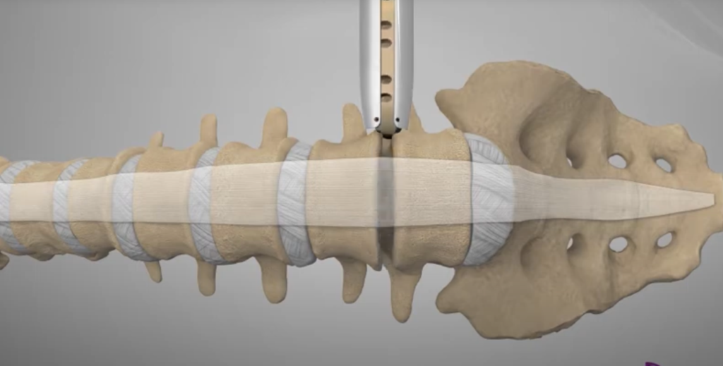 XLIF | eXtreme Lateral Interbody Fusion NYC | Spine Surgery
