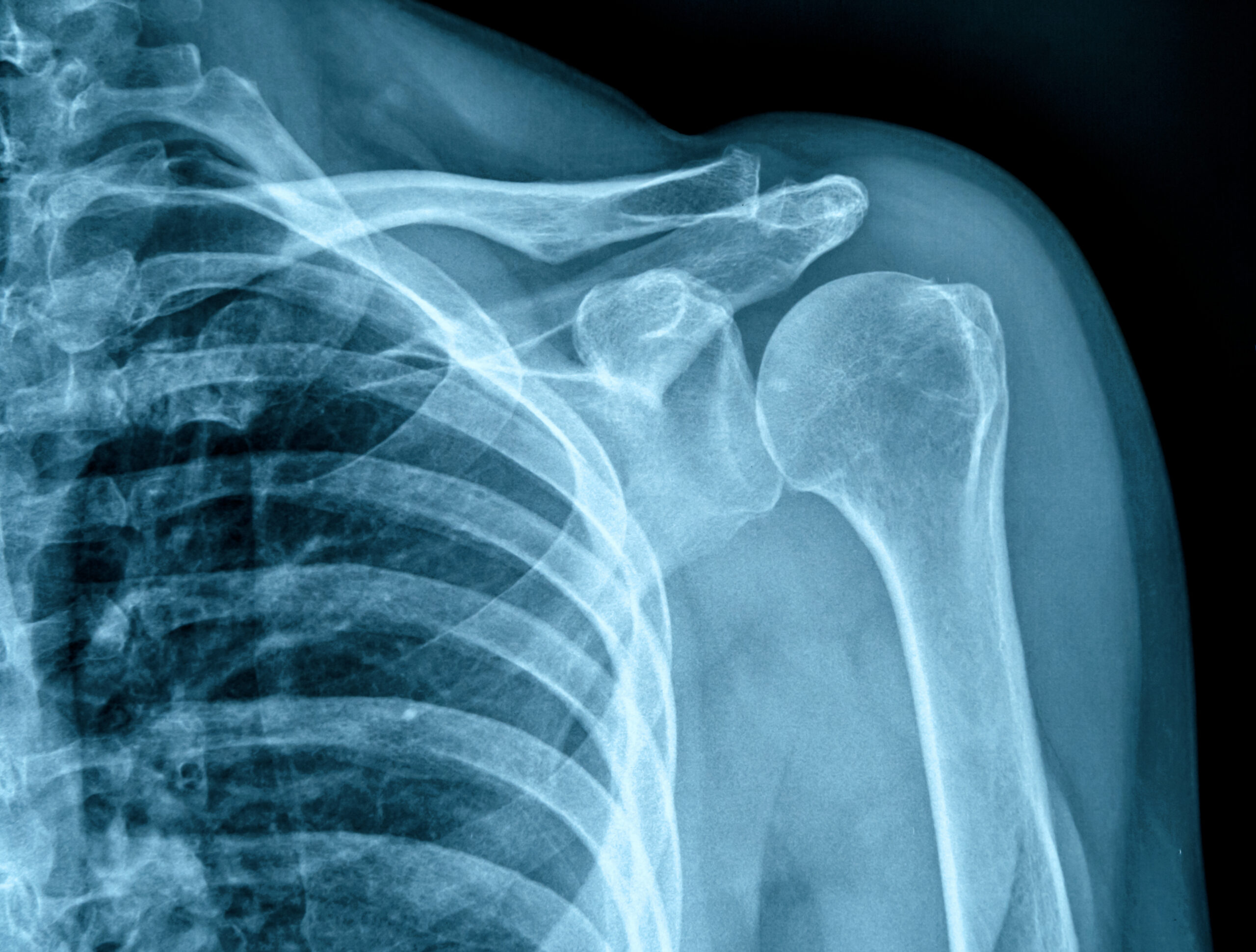 Shoulder Procedures New York City | Shoulder Orthopedic Surgeon